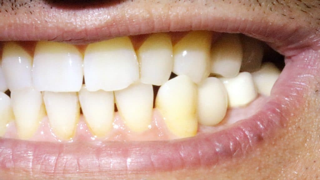 Before and After Dental Cases | Denwest Dental Clinic