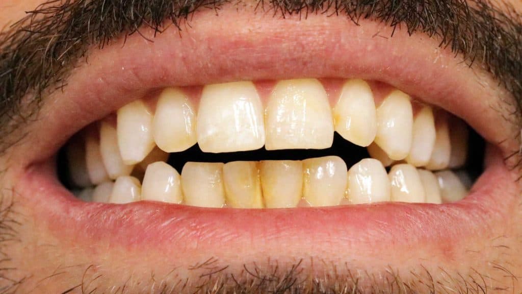 Before and After Dental Cases | Denwest Dental Clinic
